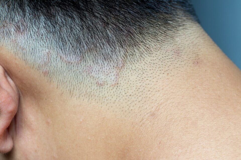 Odcisk – jak go usunąć? Czym się różni modzel od nagniotka? – Estetico